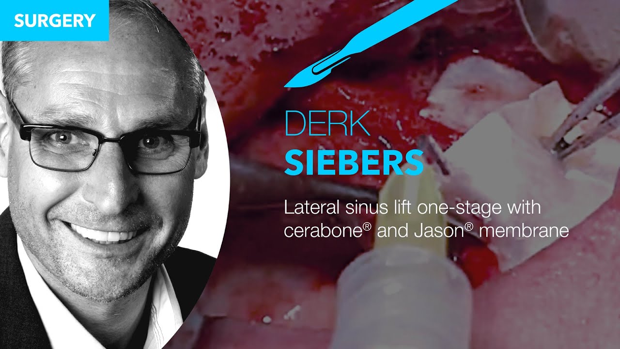 Lateral sinus lift one-stage with cerabone® and Jason® membrane ...