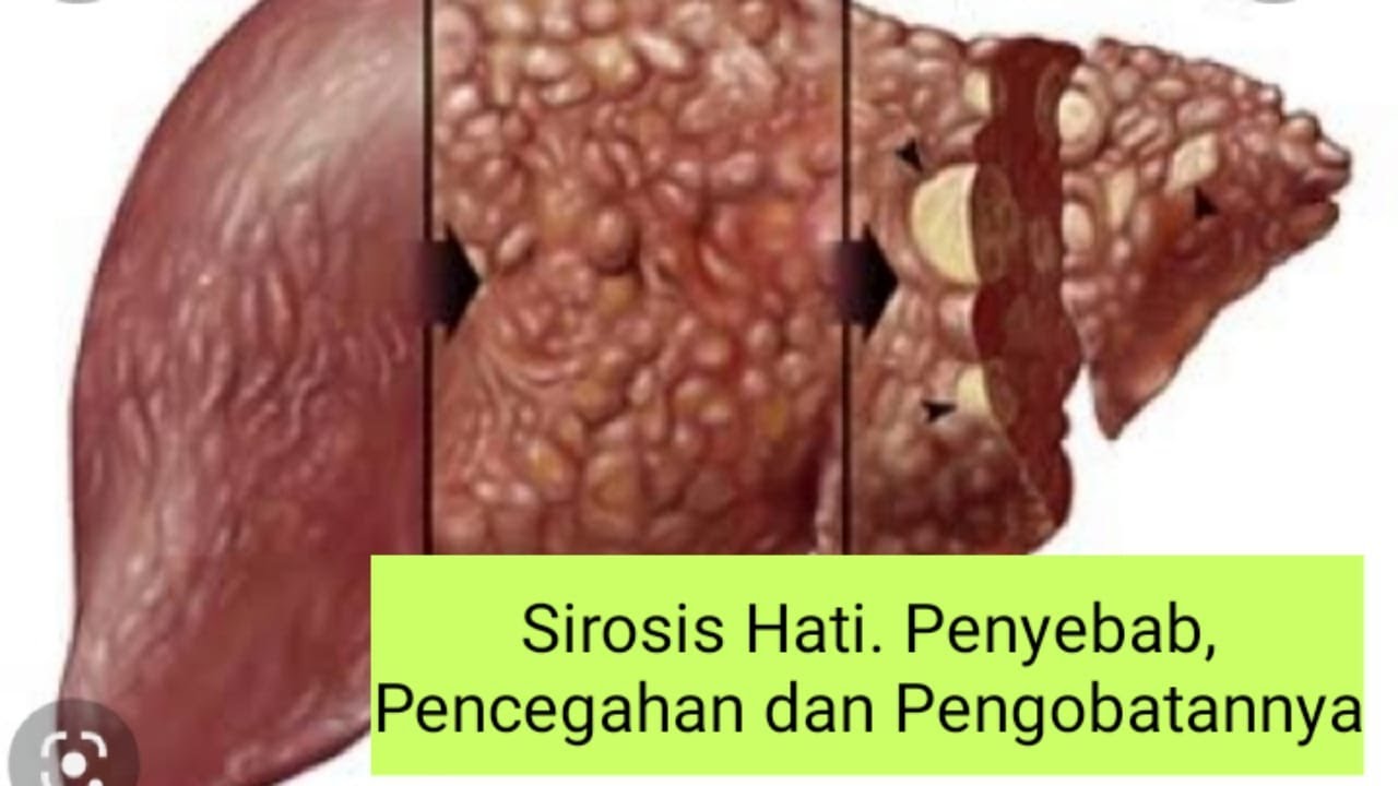 Sirosis Hati. Penyebab, Pencegahan dan Pengobatannya - YouTube