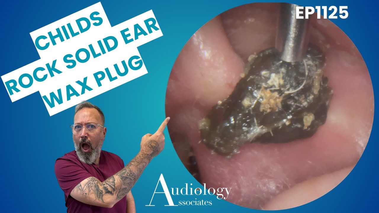 Pediatric Ear Wax Plug Removed! Satisfying Deep Extraction 👂🔥 EP1125 ...