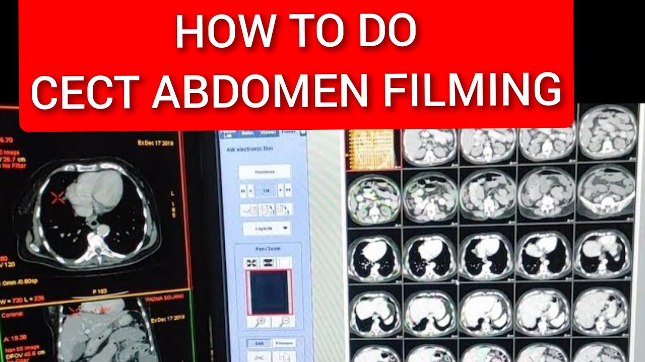CECT Whole Abdomen Filming Protocol. - YouTube