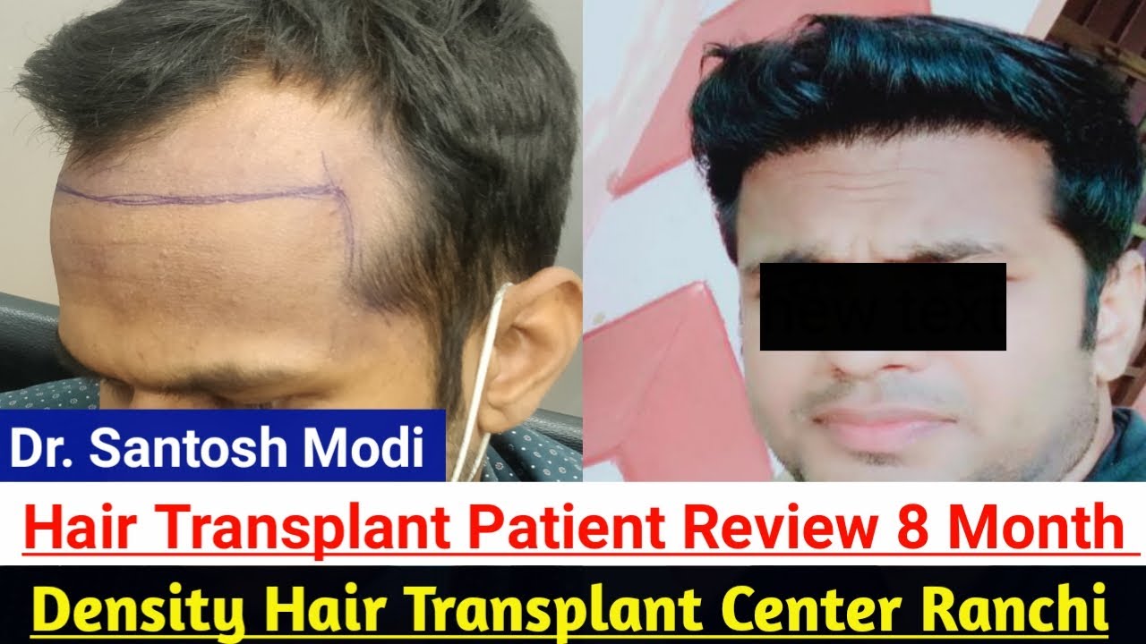 Hair Transplant Result After 8 Months | Density Hair Transplant Center ...