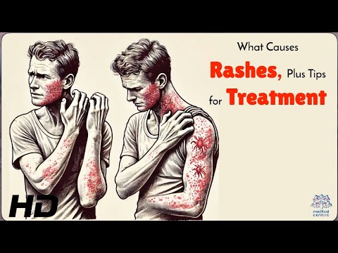 Rashes 101: Causes, Symptoms, and Quick Relief Tips - YouTube