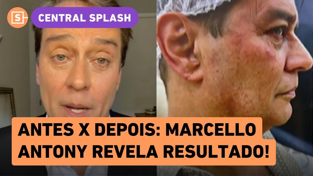 Marcello Antony faz harmonização facial e expõe resultado: 'Vou fazer ...