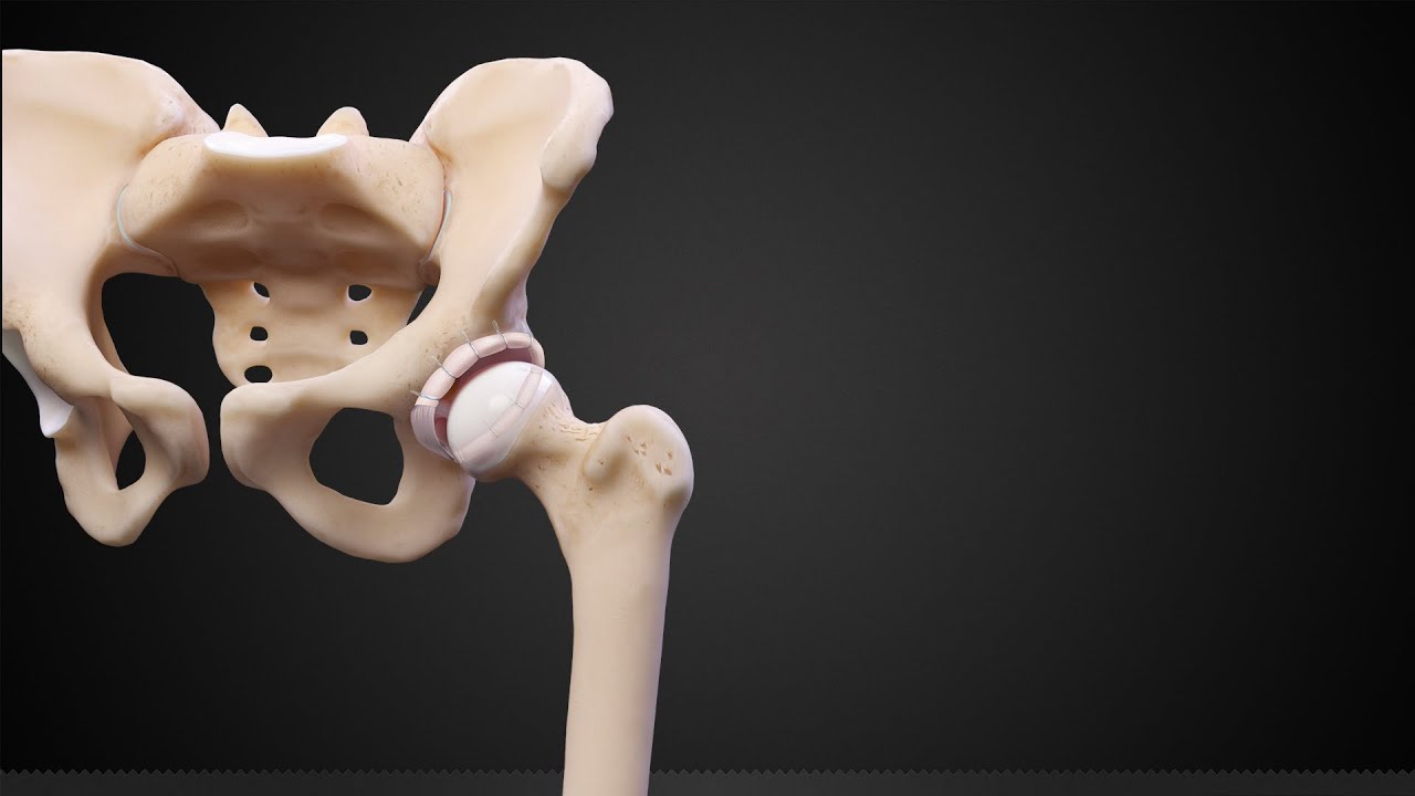 Acetabular Labral Reconstruction in Conjunction With a Periacetabular ...