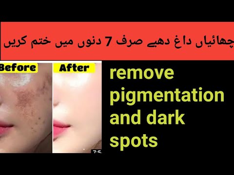 remove dark spots freckles pigmentation and acne scare| jhaiyan aur ...