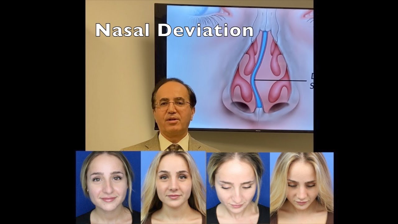 Nasal Deviation | Rhinoplasty by Dr. Ali Sajjadian | nose job! - YouTube