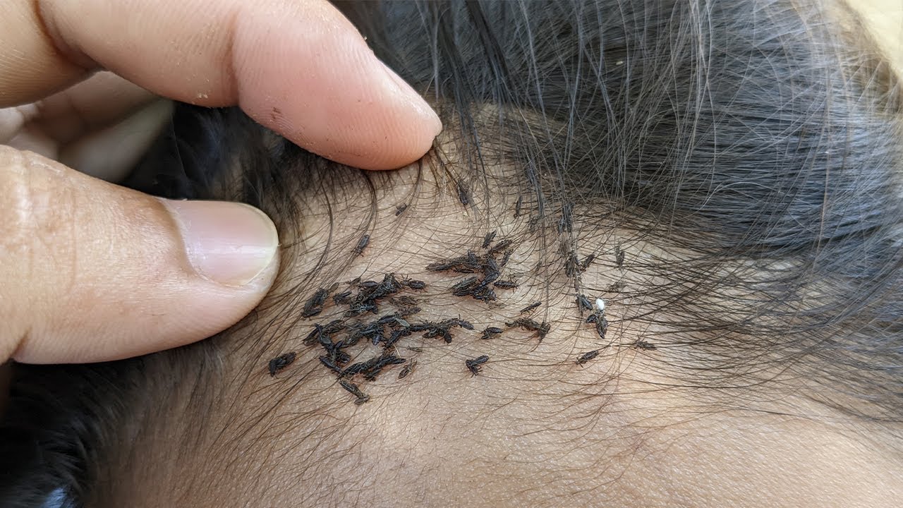 How to clear million head lice from long hair - Getting out a lot of ...