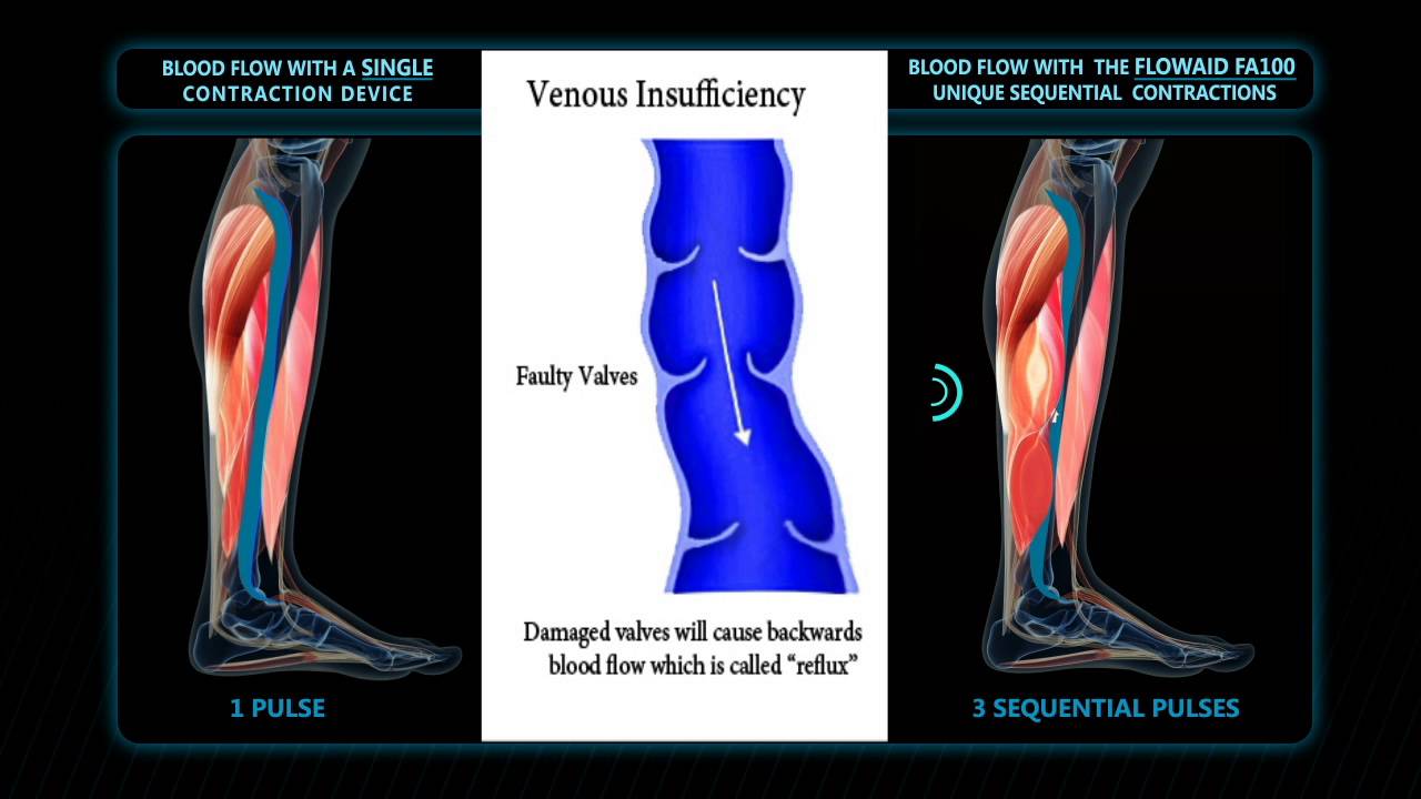 FlowAid FA100 Circulatory Enhancement Device for the Lower Limbs - YouTube