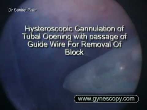 Hysteroscopic Ostial Cannulation For Blocked Fallopian Tube - YouTube