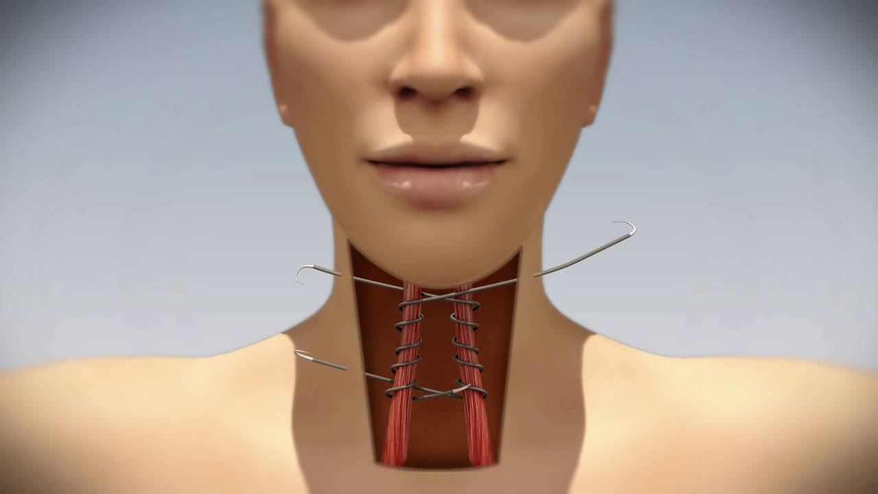 Neck surgery animation - YouTube