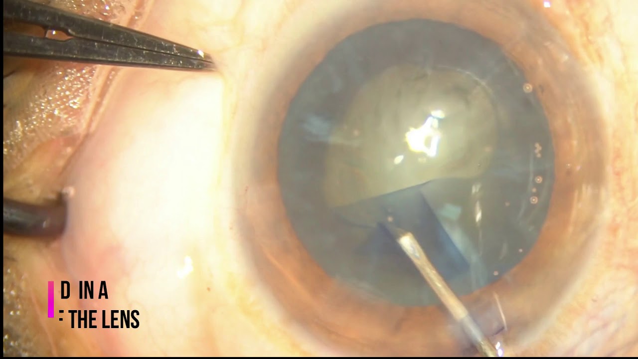CONTINUOUS CURVILINEAR CAPSULORRHEXIS IN PHACOEMULSIFICATION - YouTube