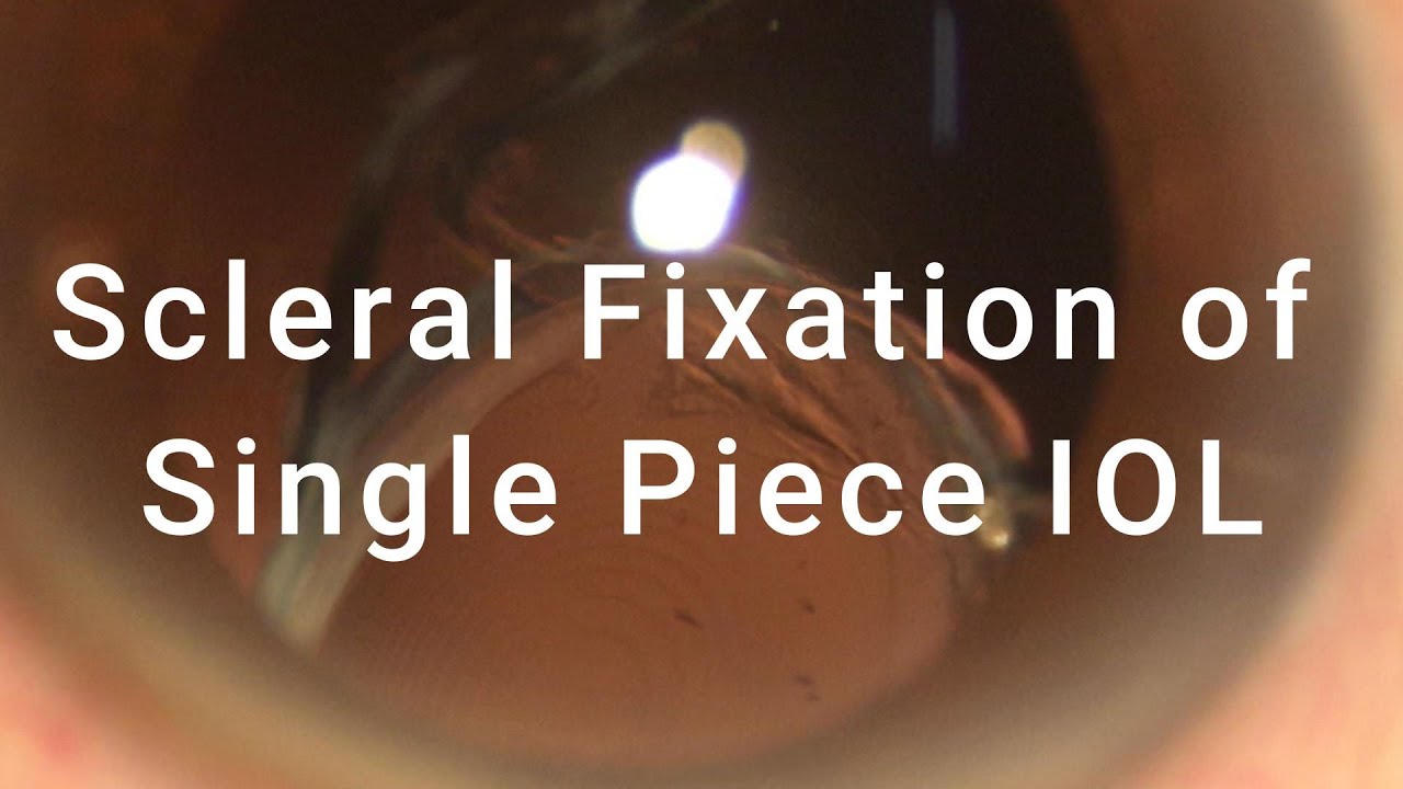 Scleral Fixation of Single Piece IOL /SFIOL / Multifocal IOL / Dr ...