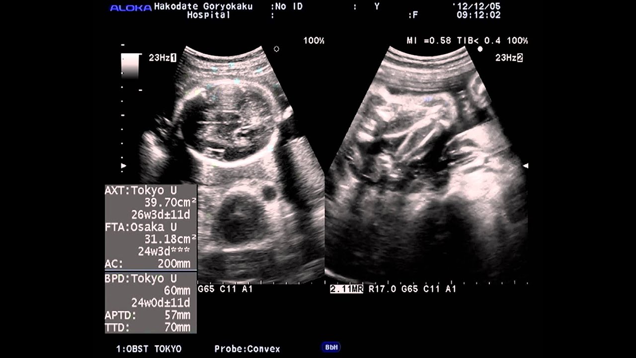 26 semaines - YouTube