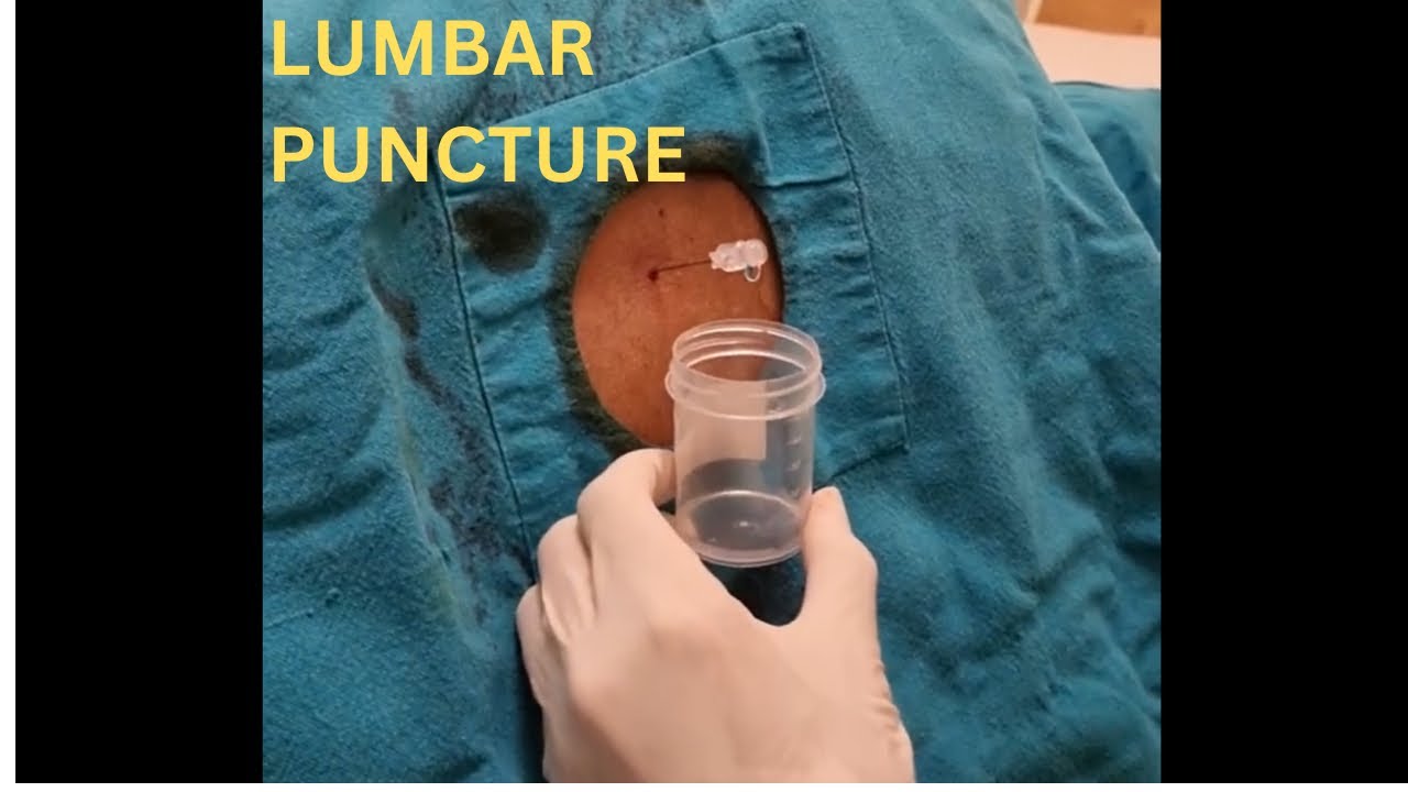 LUMBAR PUNCTURE SIMPLIFIED IN 3 STEPS - YouTube