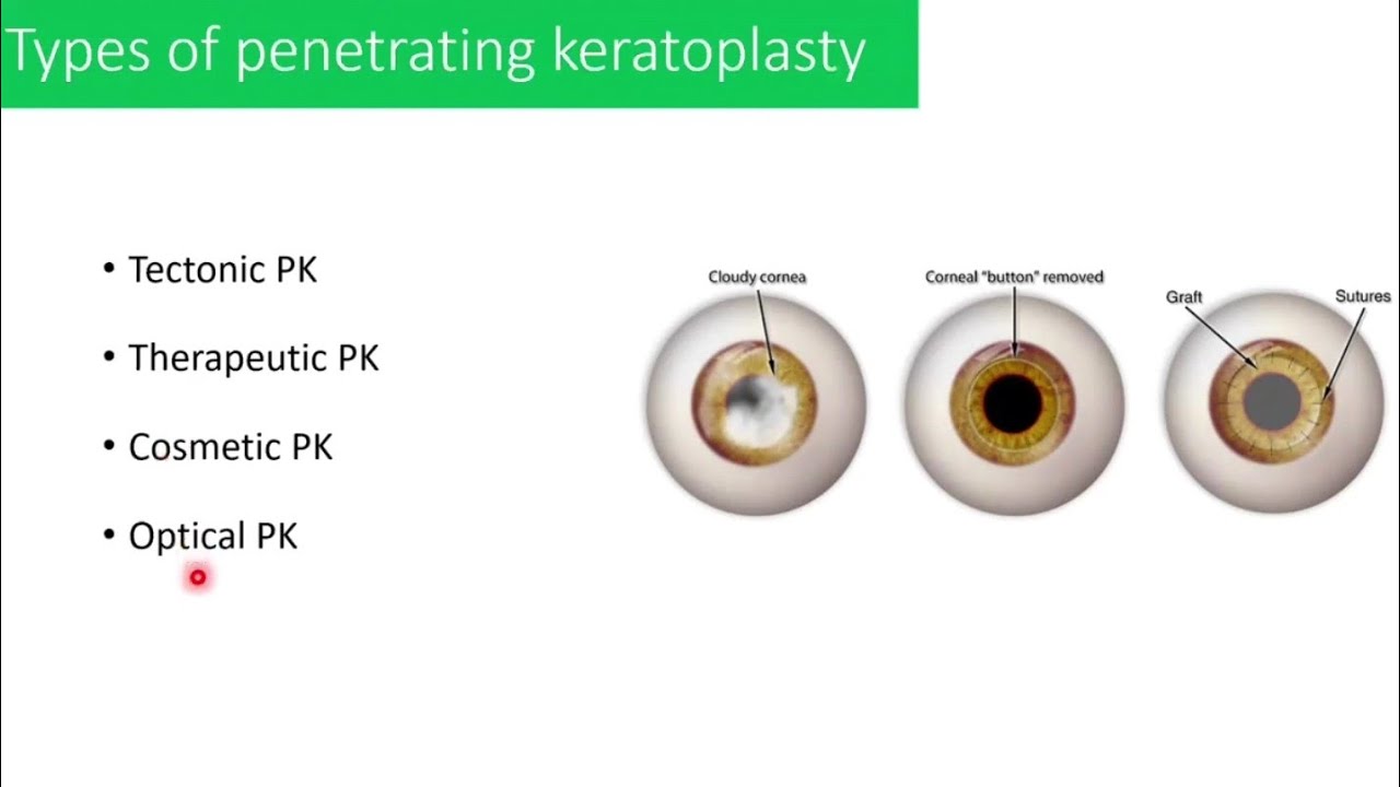 corneal transplantation part 1: Penetrating keratoplasty explained by ...