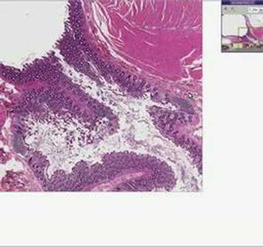 Histopathology Colon--Diverticulum - YouTube