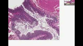 Diverticulosis Histology