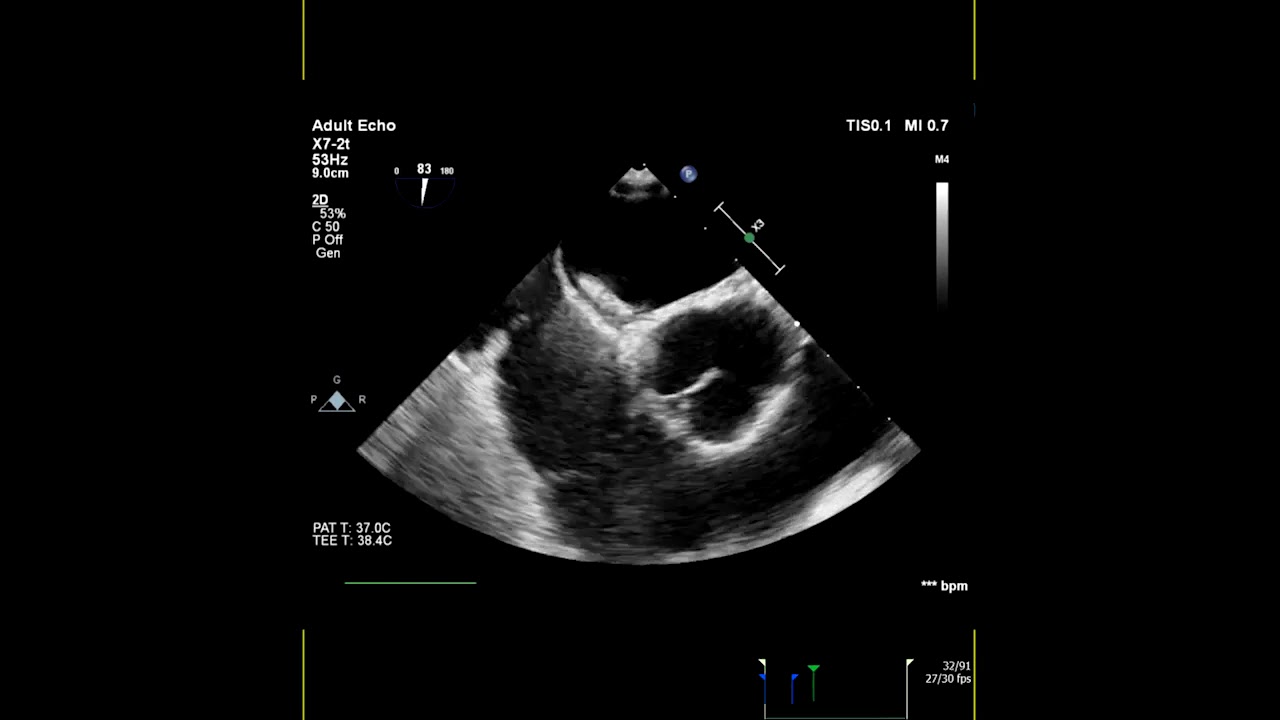 Asvide: Post-closure with a 25-mm Amplatzer PFO Occluder device - YouTube
