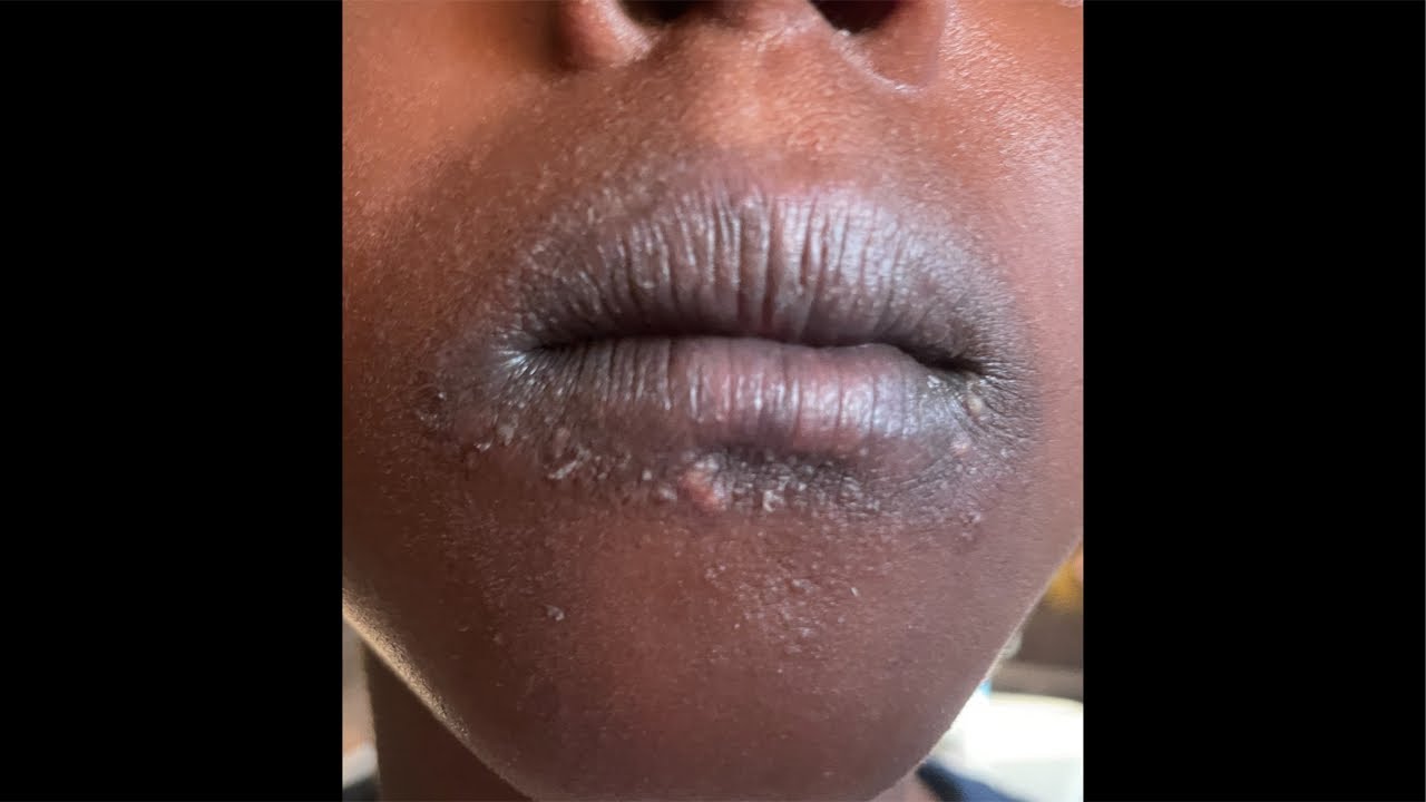 🫦👄O MY DISGUSTING LIPS!Lip licker 's dermatitis in Black skin! - YouTube