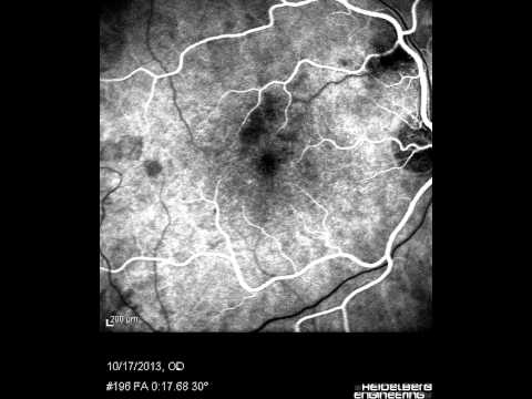 Angiogram of right eye - YouTube