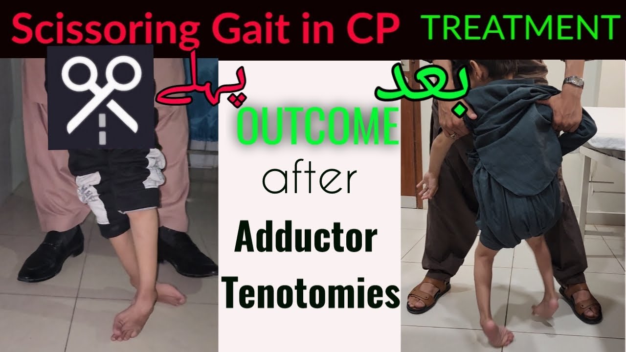CP Treatment of Scissor Gait CASE 1/Video 1/ Outcome after Adductor ...