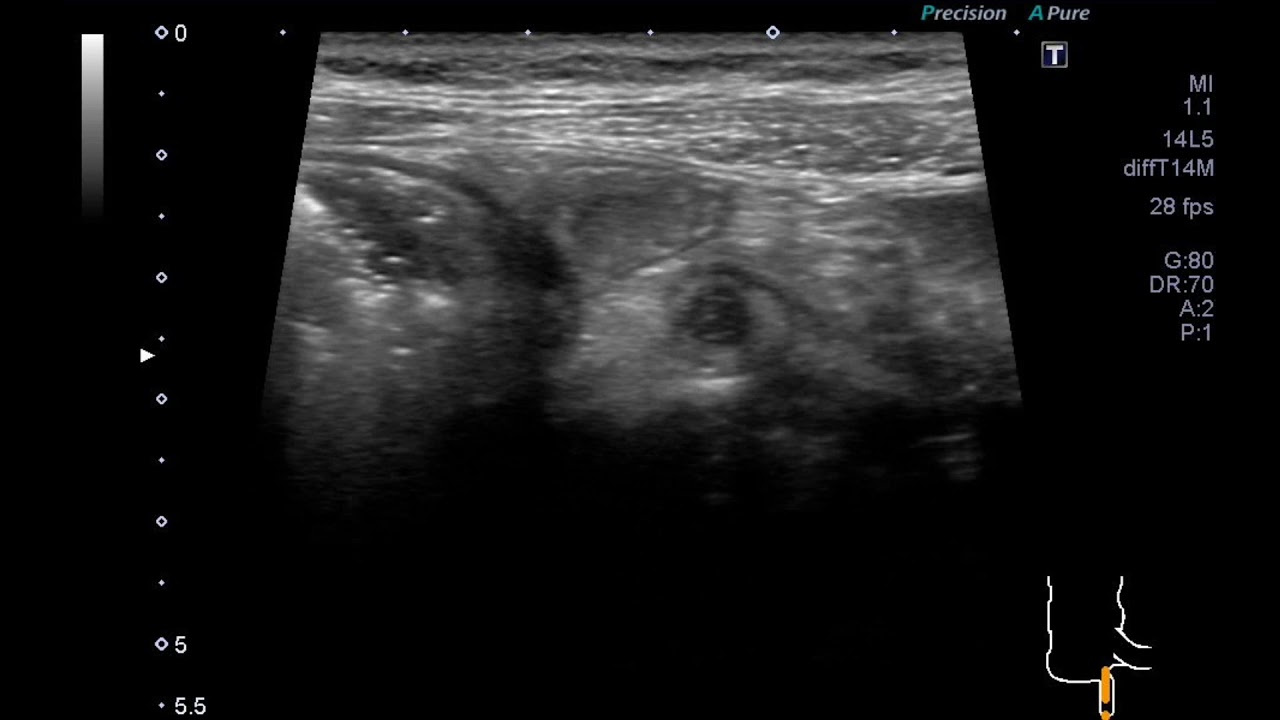 Appendicitis in Pregnant Women - YouTube