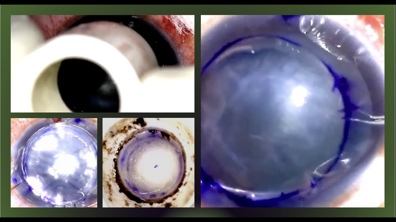 Performing Phaco and DSAEK (endothelial keratoplasty) - what every ...