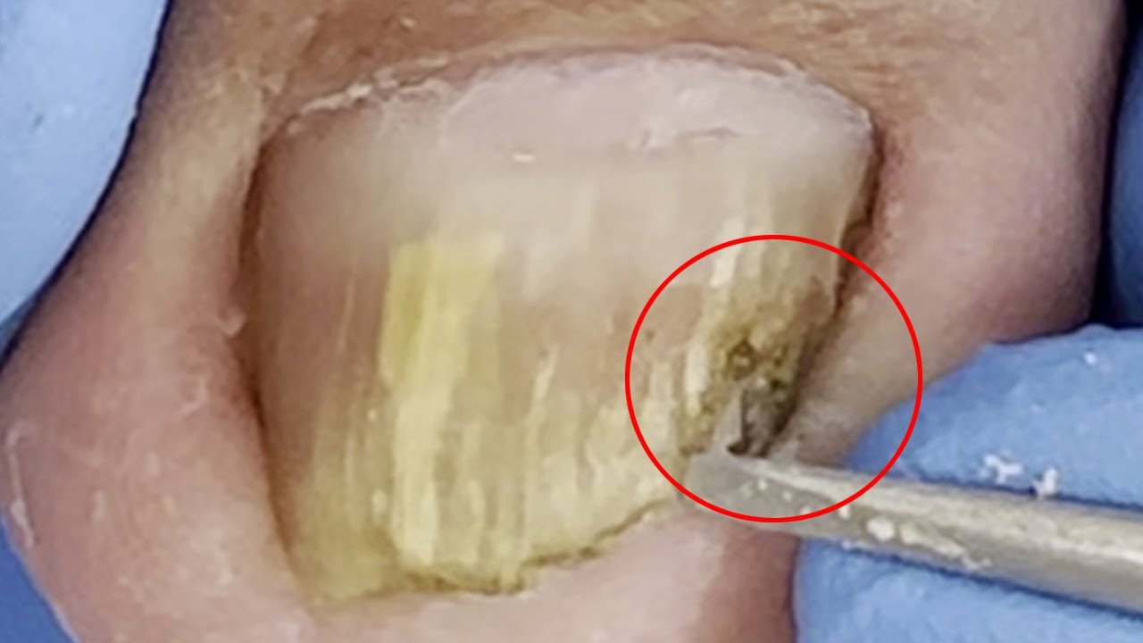 Clean up the broken nail fungus!【Xue Yidao】 - YouTube