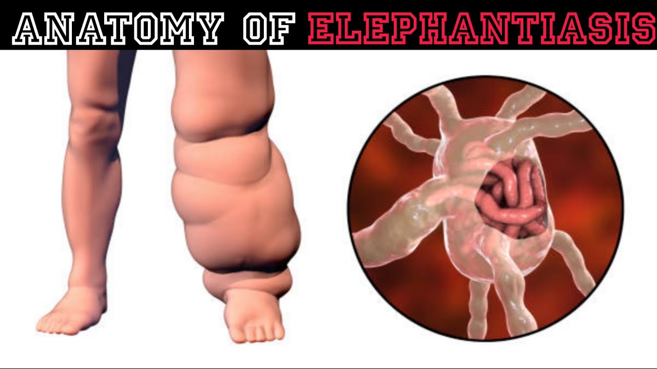 Elephantiasis | Symptoms | Causes | Treatement - YouTube