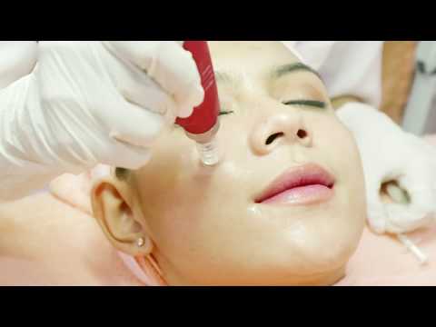 Hilangkan bekas jerawat (Flek) pori pori besar dengan treatment Dermapen PRP