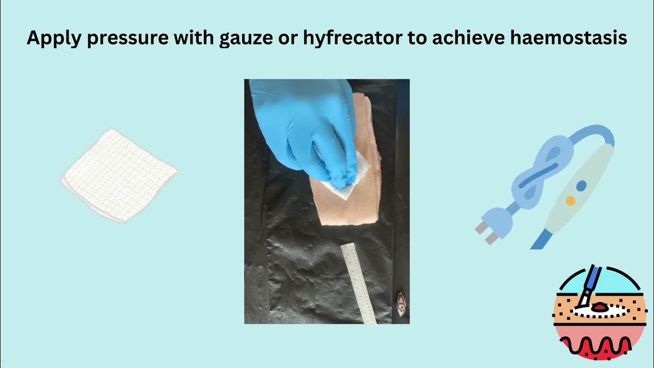 How To Perform an Ellipse Excision - Vaseharan Suntharan - YouTube