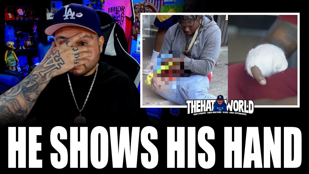 4xtra Finally Shows His Hand After Fireworks Accident… This Changes ...