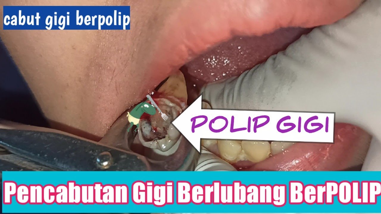 Pencabutan Sederhana Geraham Bawah Berlubang Besar dan Ada Polip ...