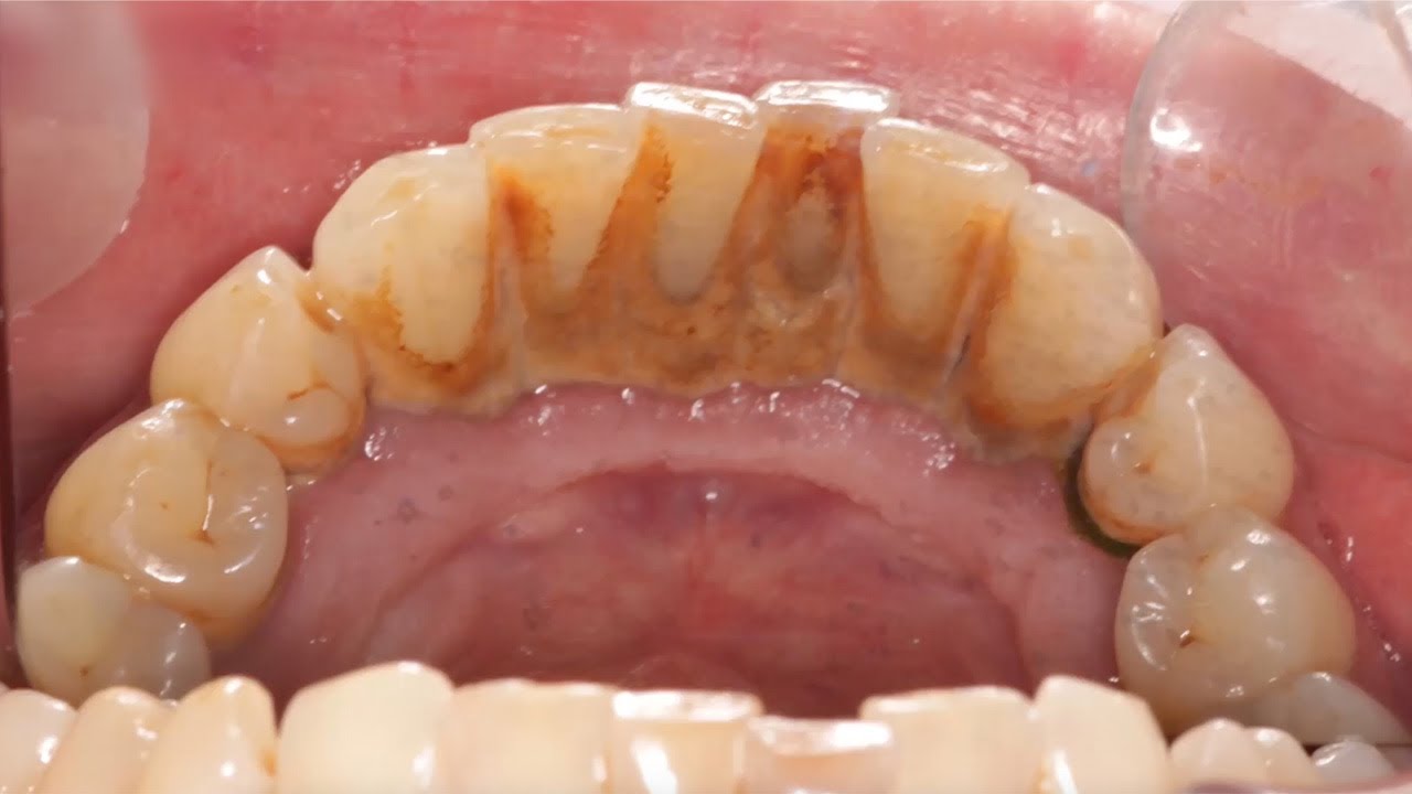🦷 Watch Tooth Modeling Magic! 😲 See How Dentists Create Perfect Smiles ...