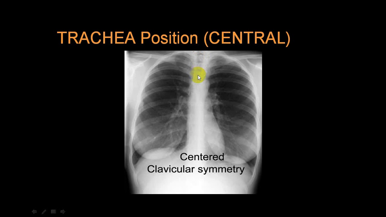XRAY CHEST TRACHEA & DIAPHRAGM - YouTube