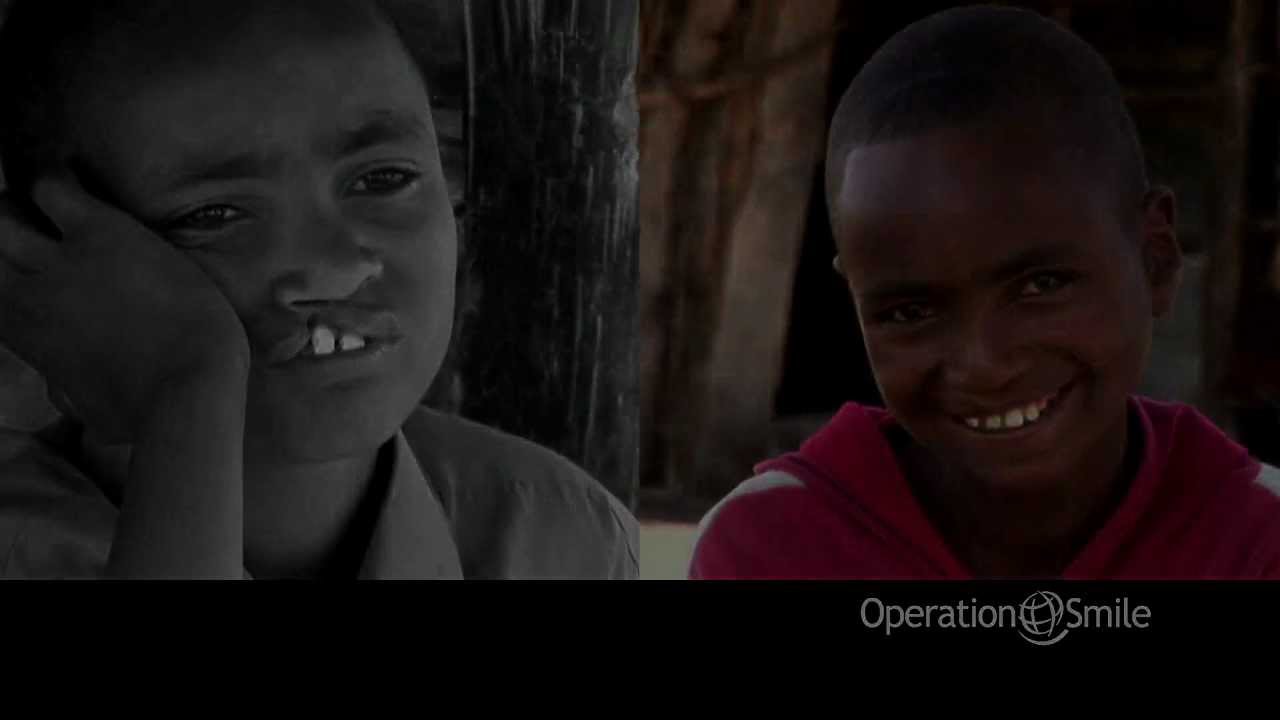 Cleft Lip And Palate Before And After Operation Smile