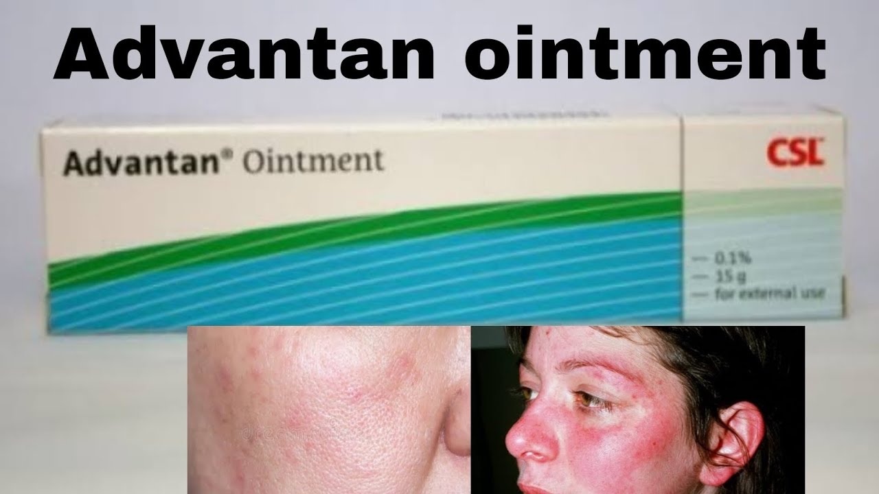 Advantan ointment | Use | Side Effects | Benefits | price #review # ...