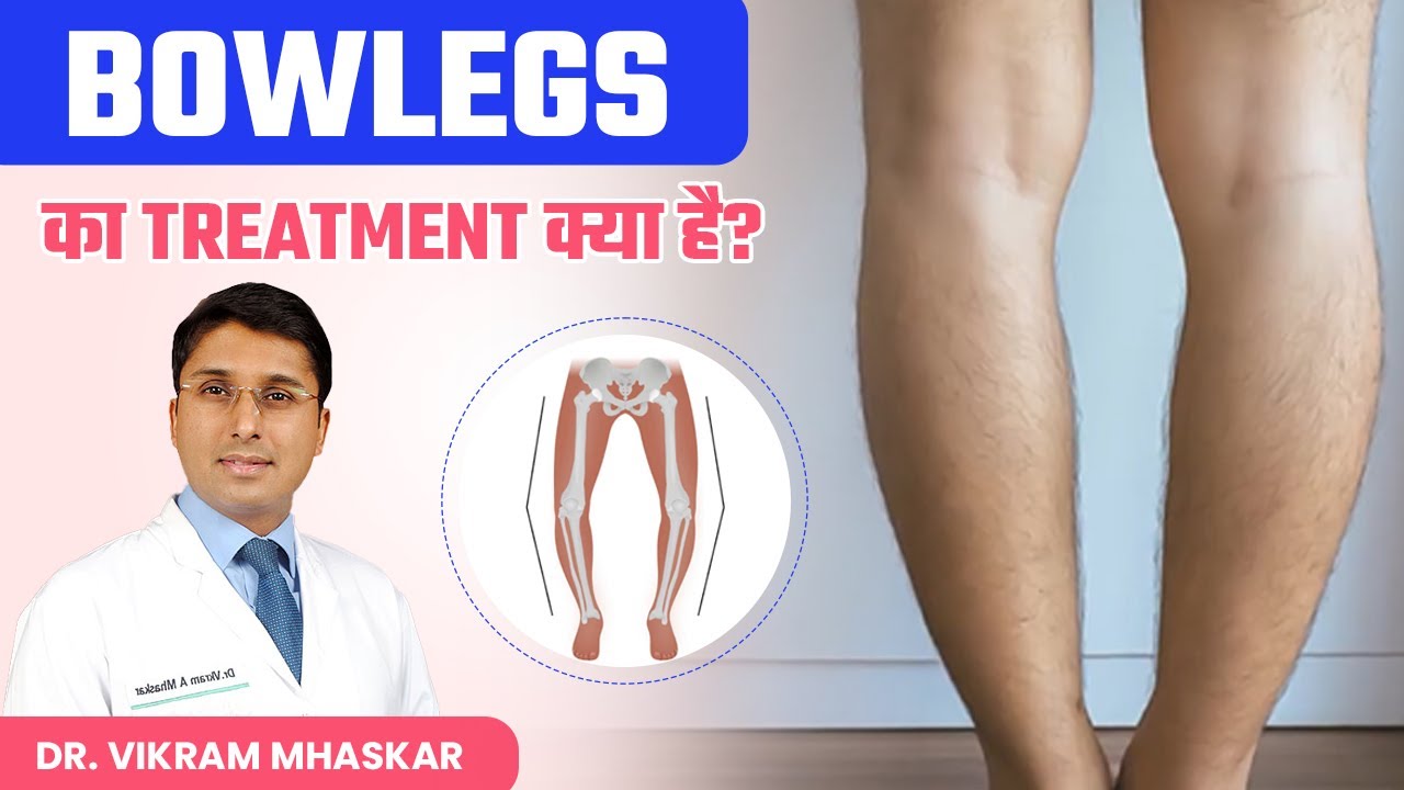 Bow Legs का Treatment क्या है? | Bow Legs को कैसे ठीक किया जाता है ...