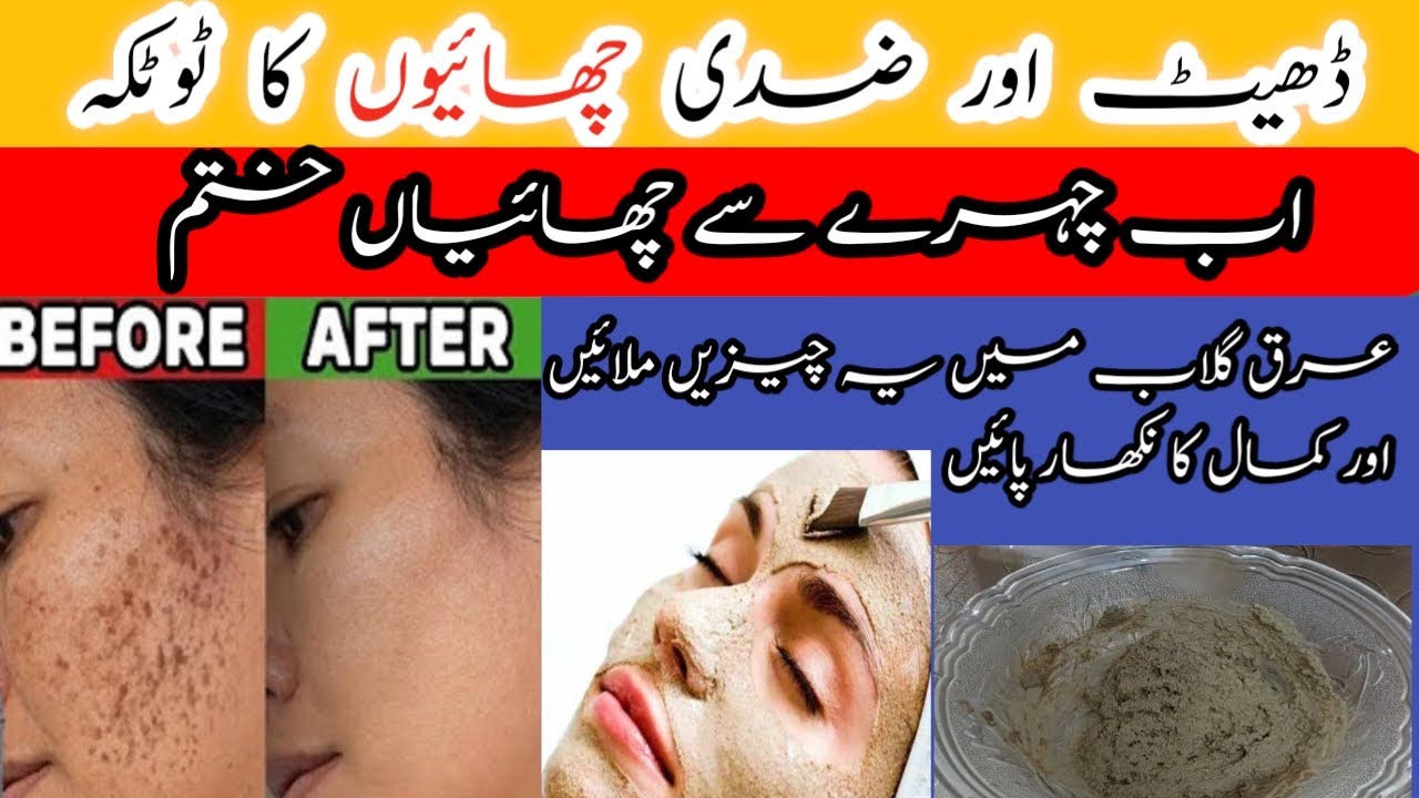 How to get rid of Freckles /Melasma / Dark spots and pigmentation ...