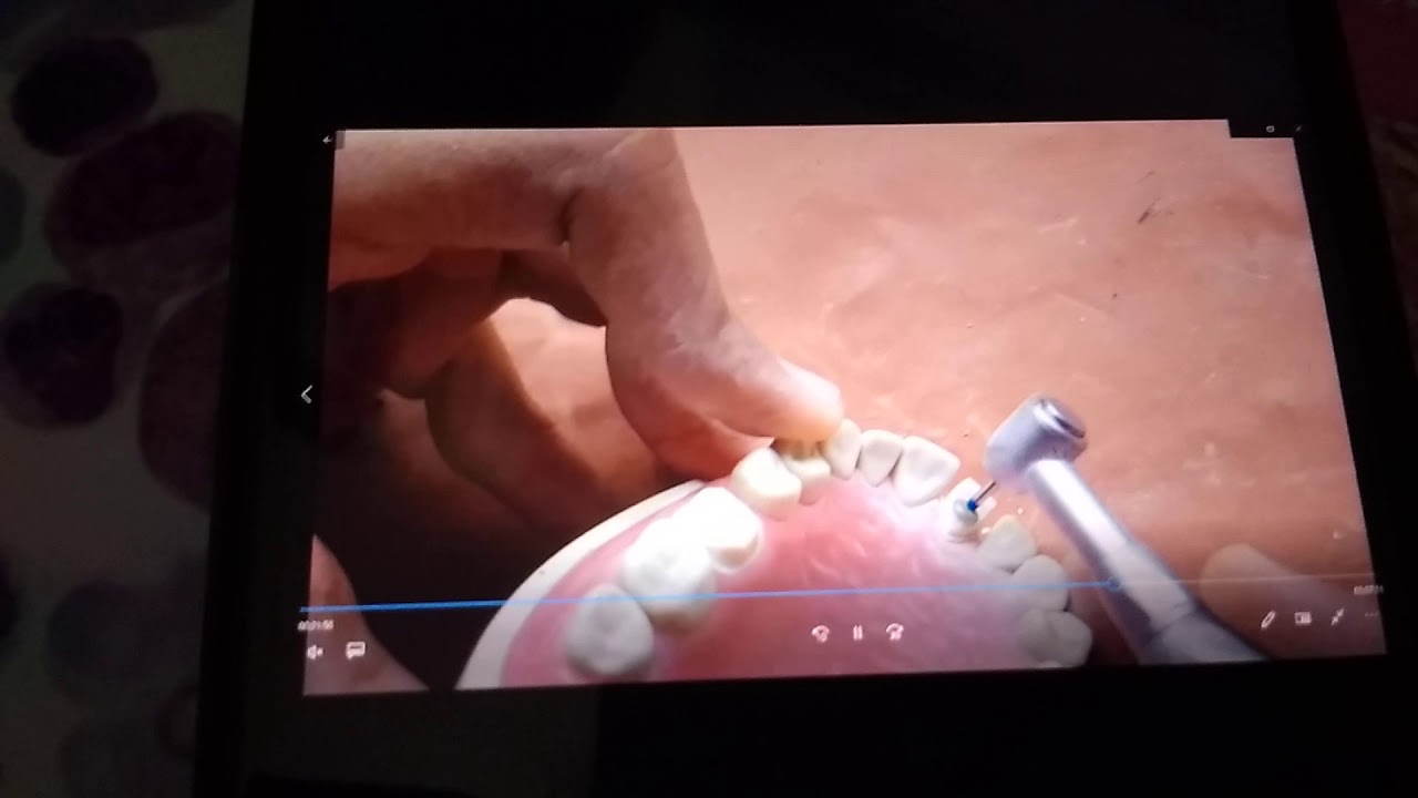 Crown preparation - YouTube