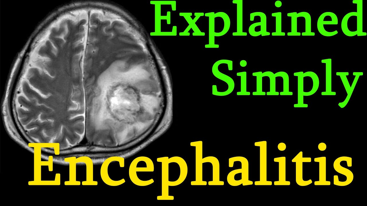 Encephalitis - brain inflammation - Symptoms, causes, prognosis ...