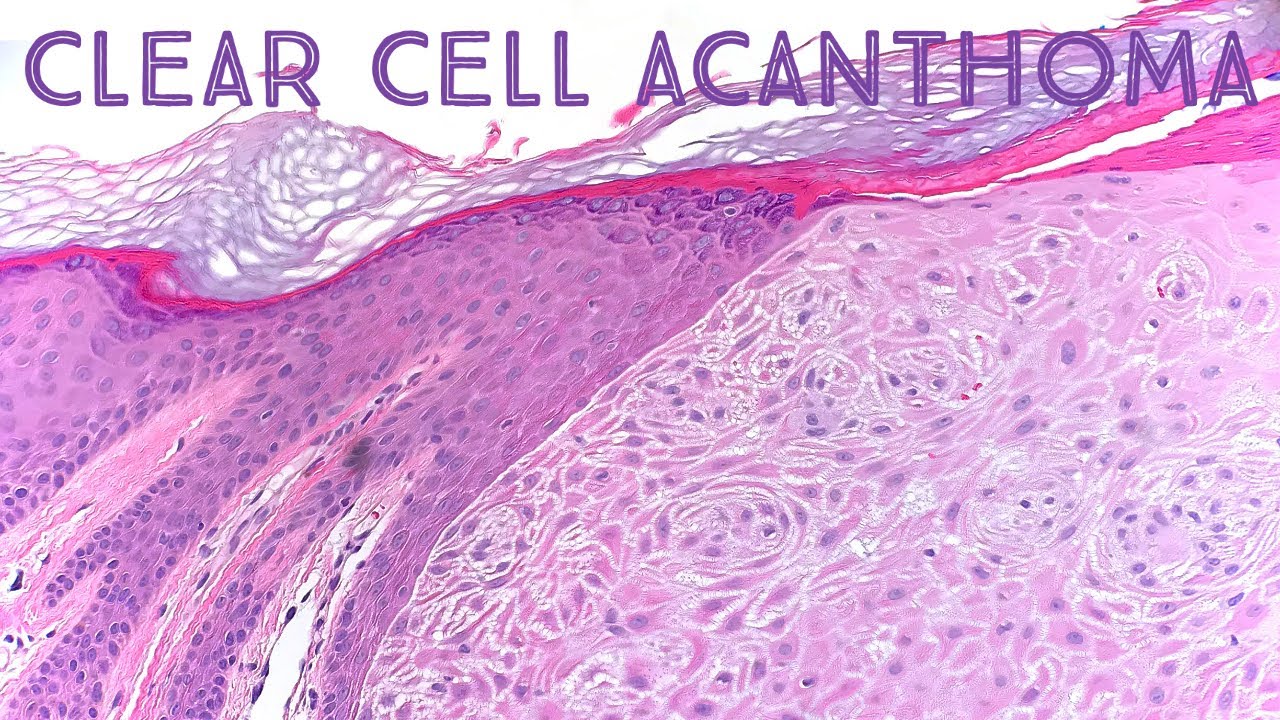 Clear Cell Acanthoma: Dermpath in 5 Minutes (pathology dermatology ...