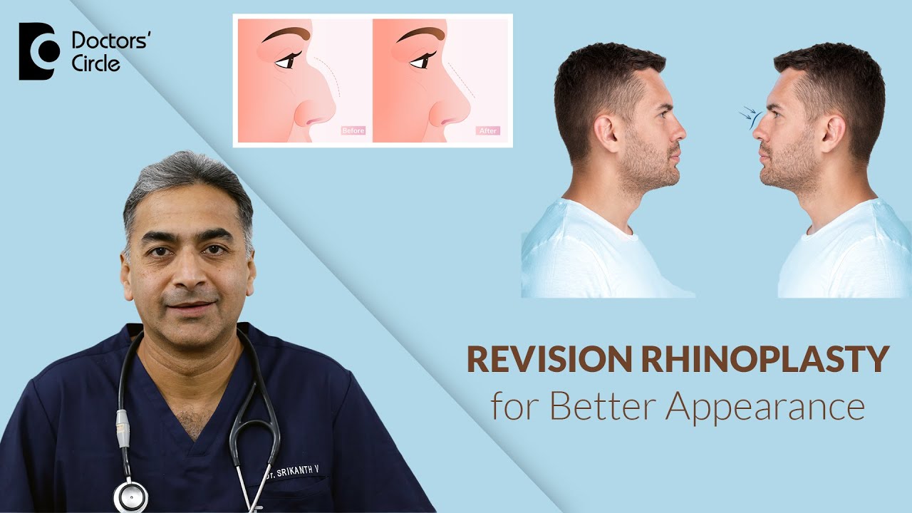 Revision Rhinoplasty | How many Revisions can one have for Nose Job ...