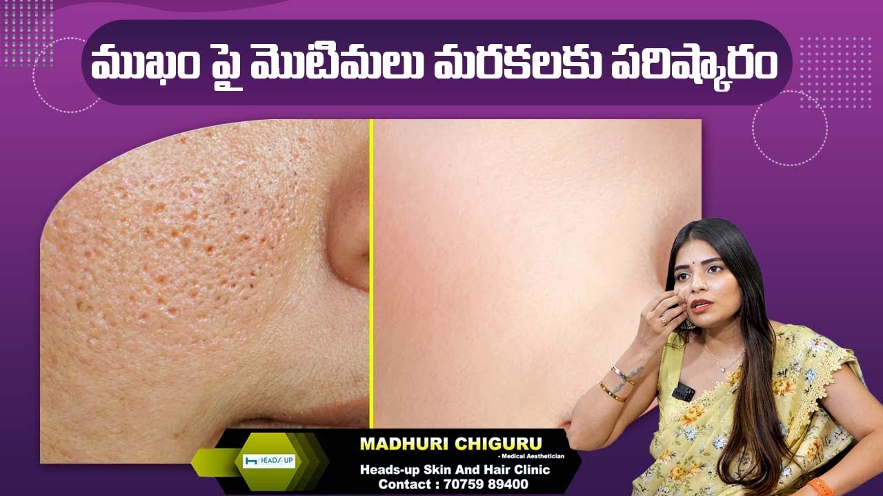 How To Treat Open Pores Pimples Removal Causes And Treatment