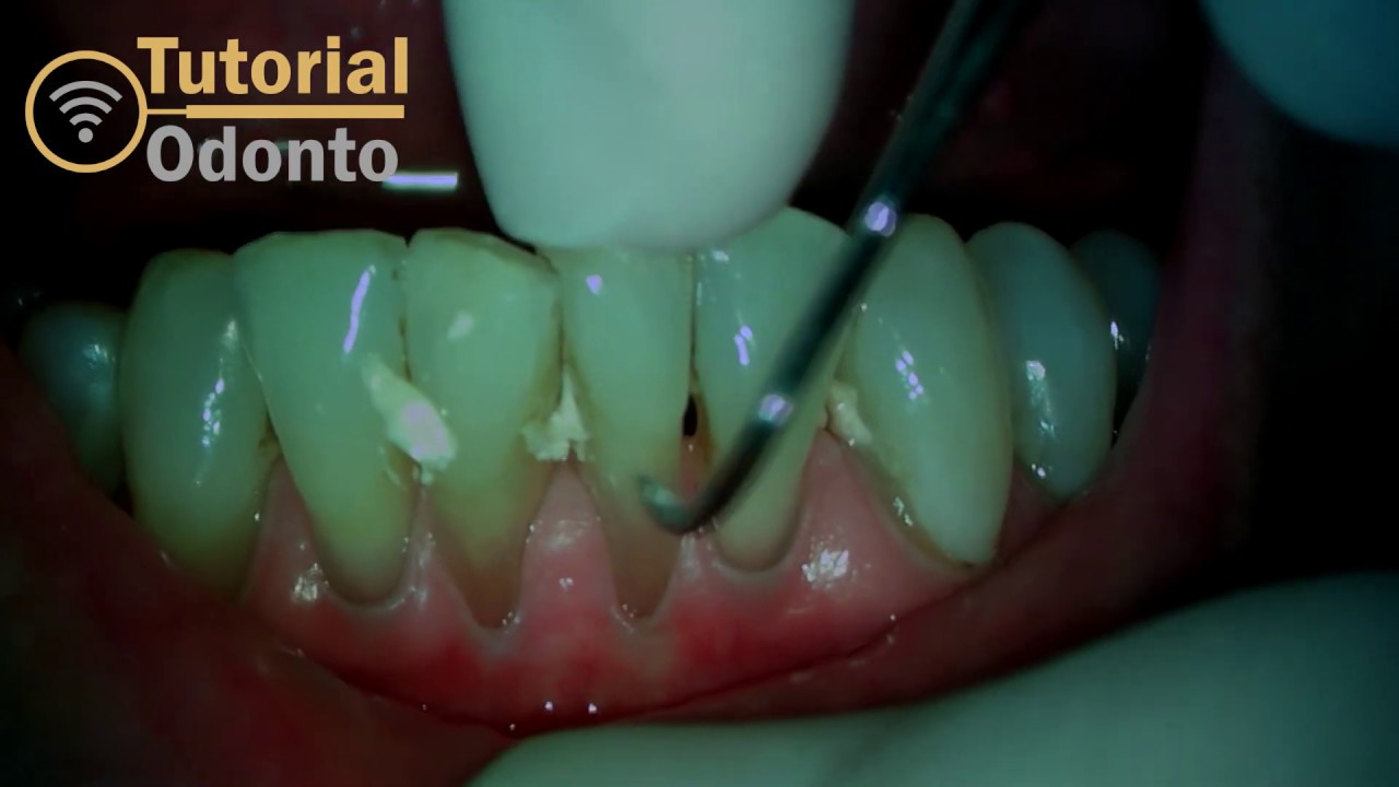 Raspagem supragengival - YouTube