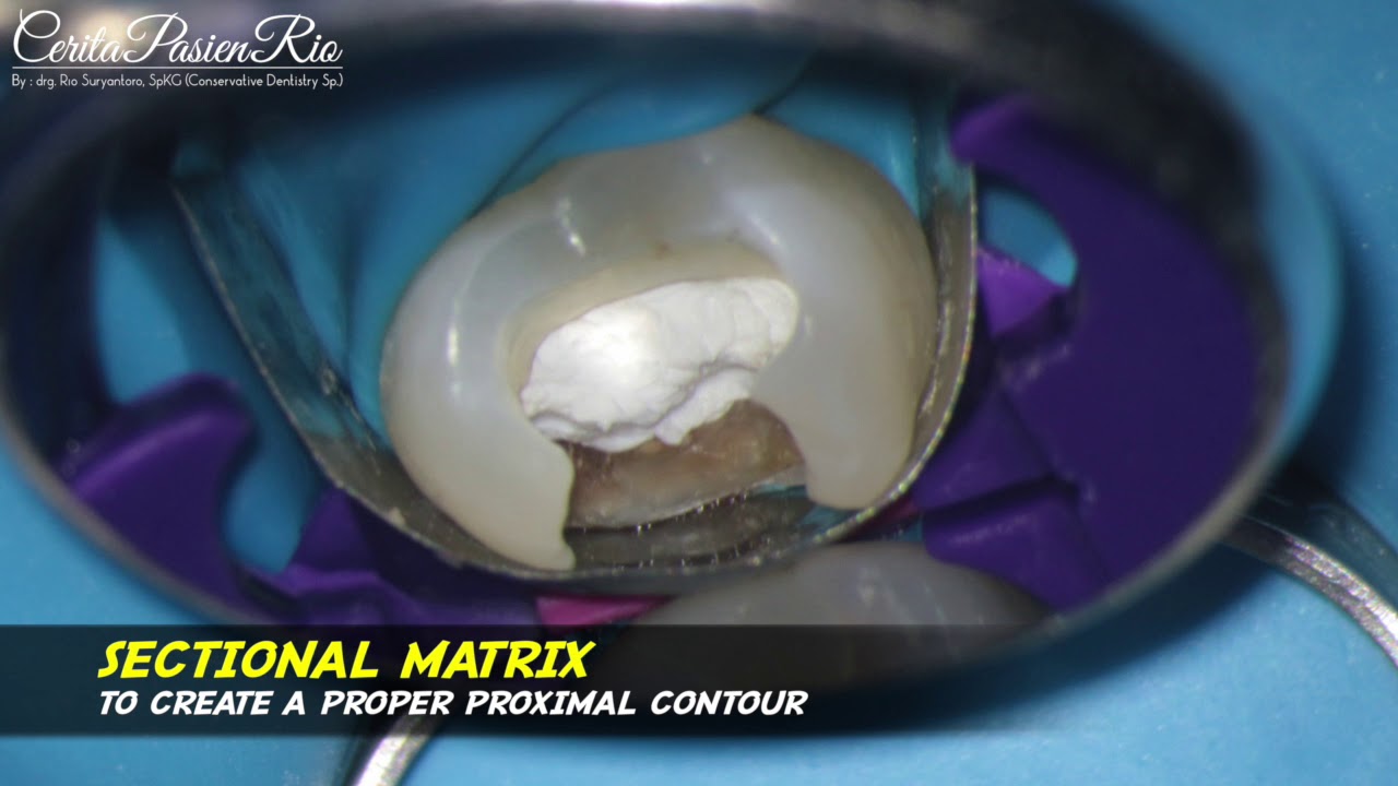 rewalling pre endodontic build up tokuyama palfique universal flow ...