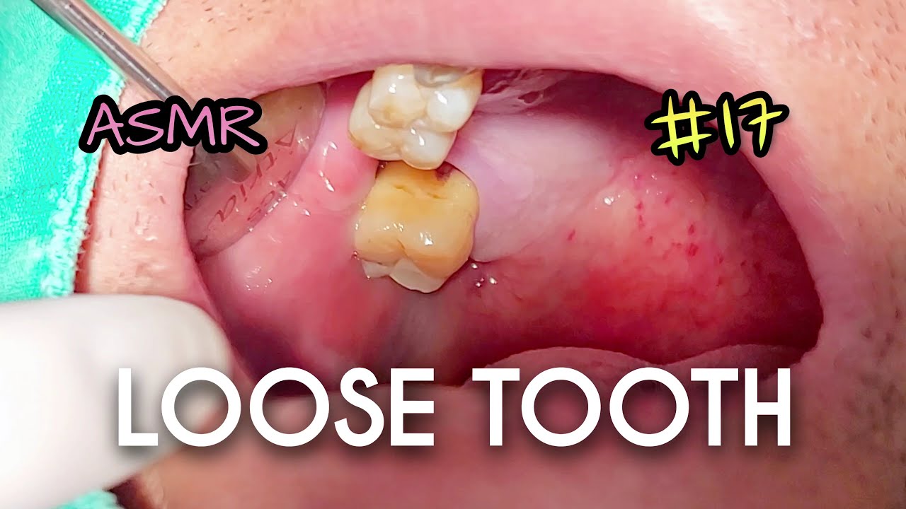 [ASMR] Loose Tooth Extraction - YouTube