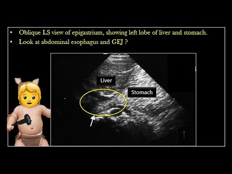 Paediatric Ultrasound - Approach to Neonatal Vomiting - YouTube
