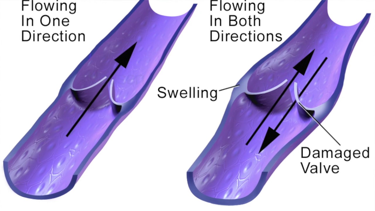 What are venous stasis leg ulcers? Complications of Venous ...