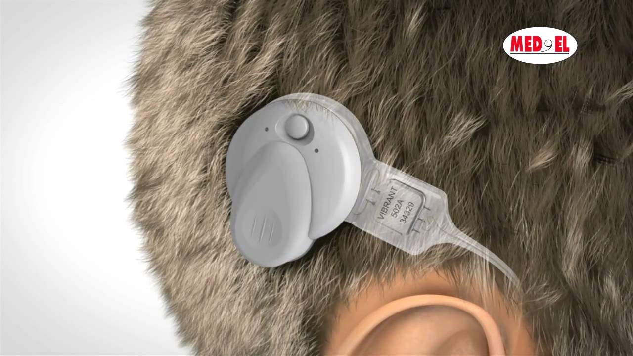 Video del Sistema de Implante de Oido Medio VIBRANT SOUNDBRIDGE | MED ...